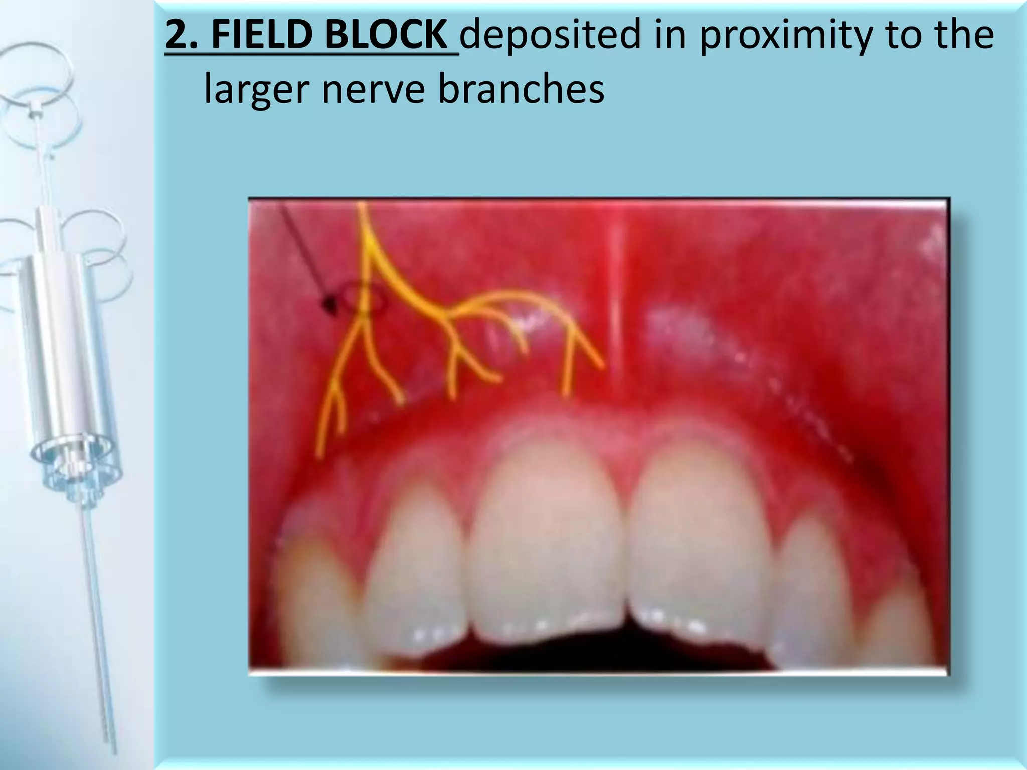 "LOCAL-ANAESTHESIA" | PPTX