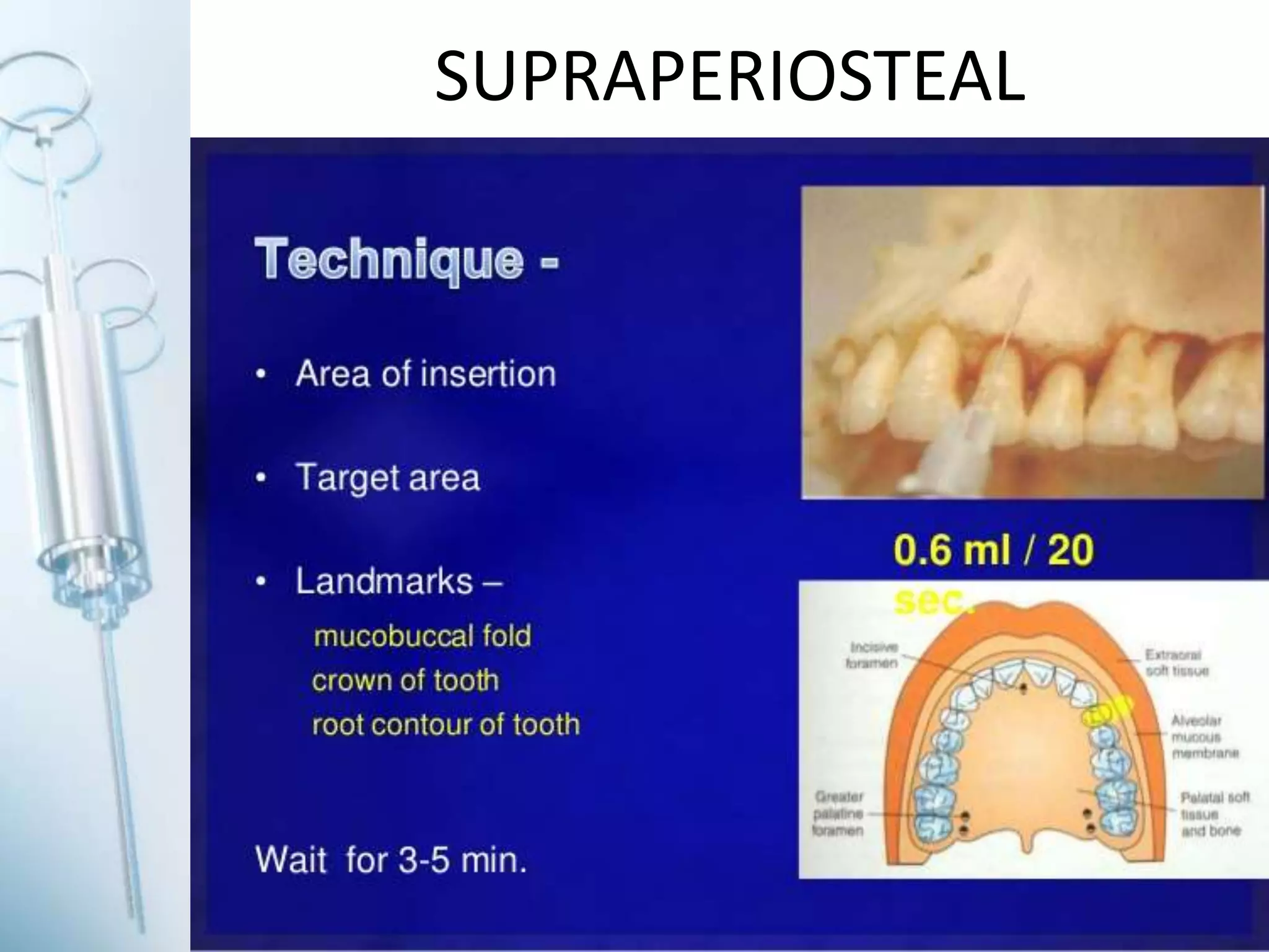 "LOCAL-ANAESTHESIA" | PPTX