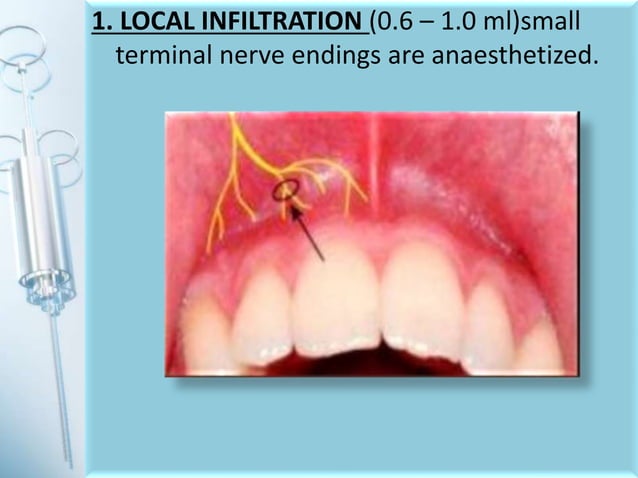 "LOCAL-ANAESTHESIA" | PPTX | Chemistry | Science