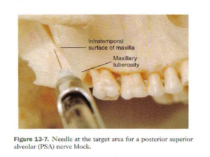 Local anaesthesia and techniques for pedodontics