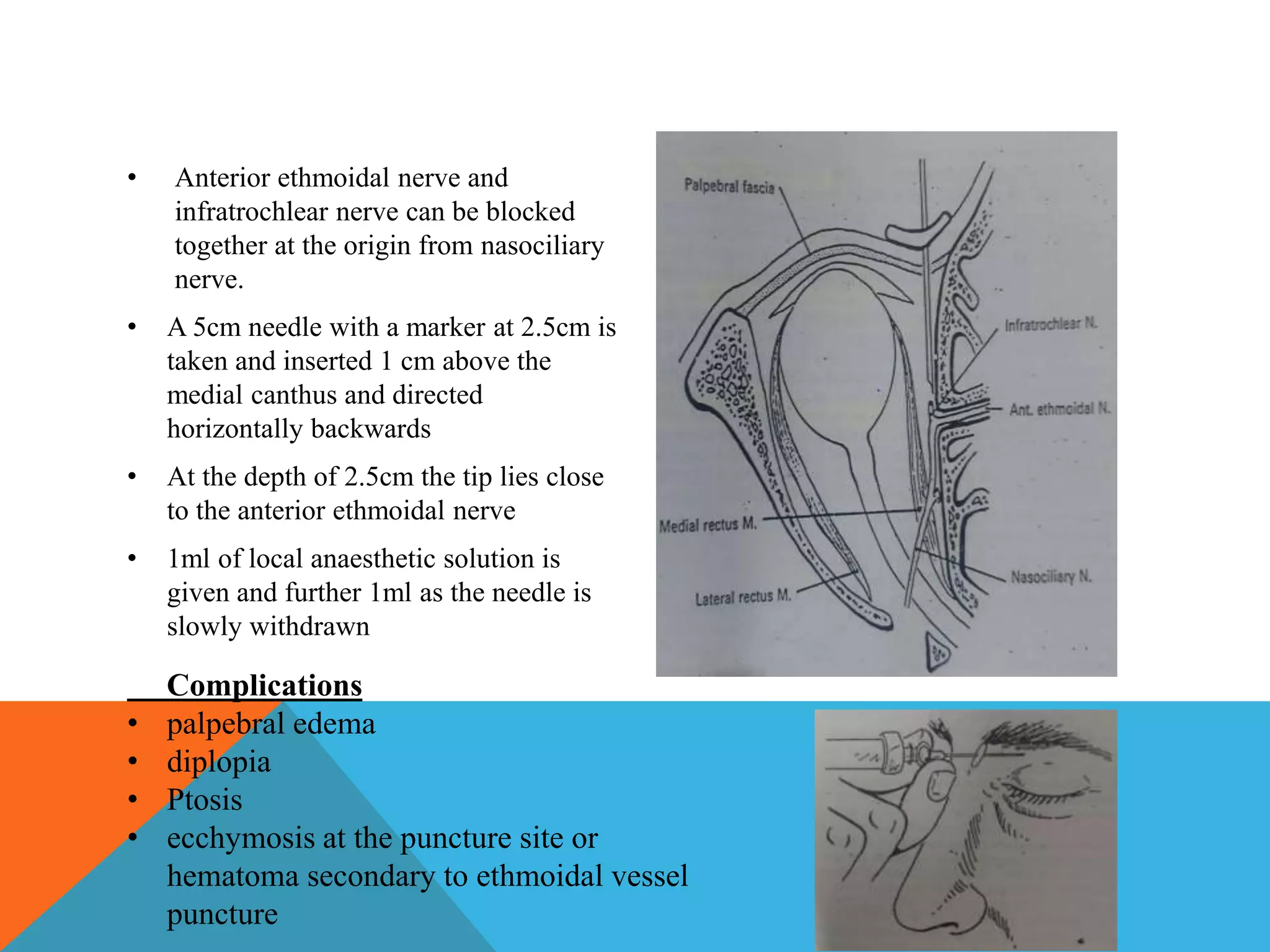 Local anaesthesia blocks in ent | PPTX