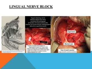 Local anaesthesia blocks in ent | PPTX