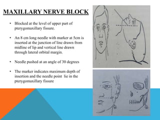 Local anaesthesia blocks in ent | PPTX