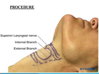 Local anaesthesia blocks in ent | PPTX