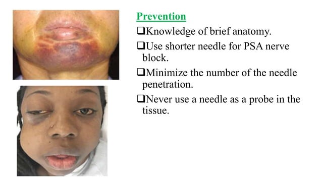 Local anaesthesia complications | PPT