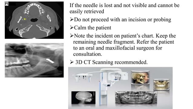 Local anaesthesia complications | PPT