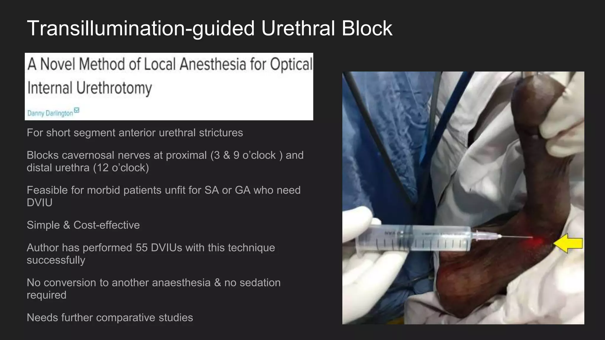 Local anaesthesia for penile procedures | PPTX