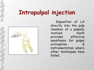 Local anaesthesia _pedo_ | PPT