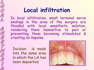 Local anaesthesia _pedo_ | PPT