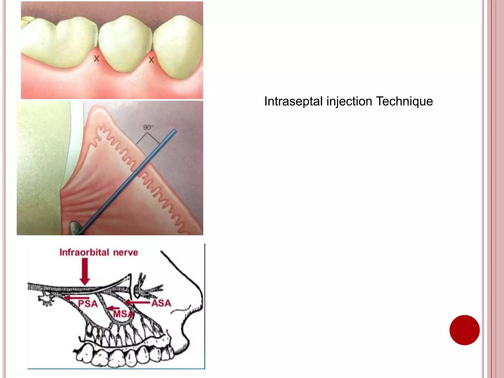 Local anaesthesia in dentistry | PPTX