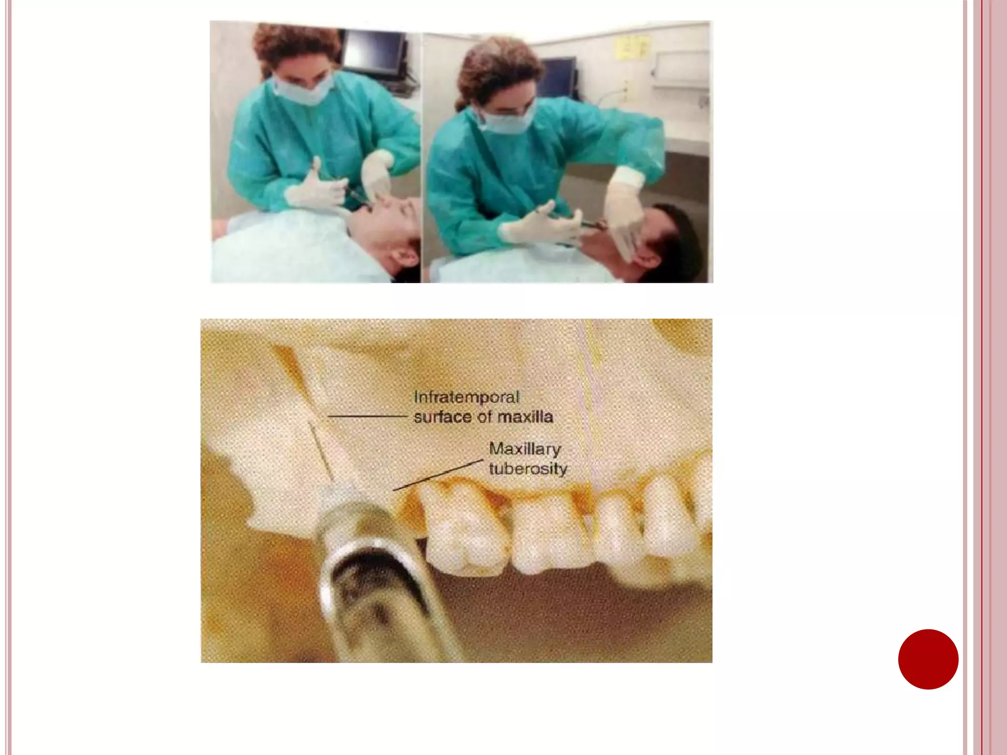 Local anaesthesia in dentistry | PPTX