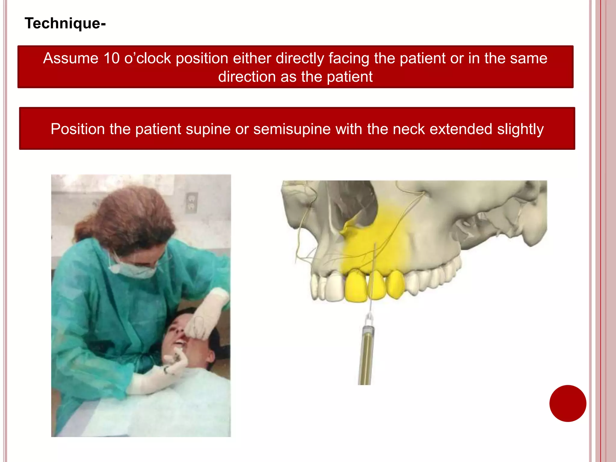 Local anaesthesia in dentistry | PPTX