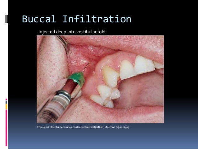 An introduction to local anaesthesia in dentistry