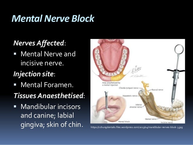 An introduction to local anaesthesia in dentistry