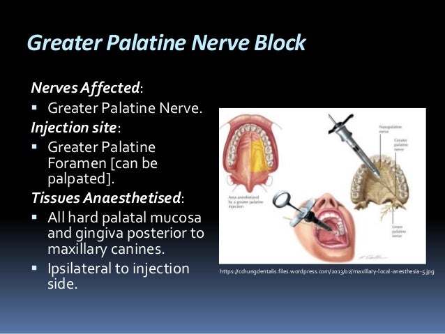 An introduction to local anaesthesia in dentistry