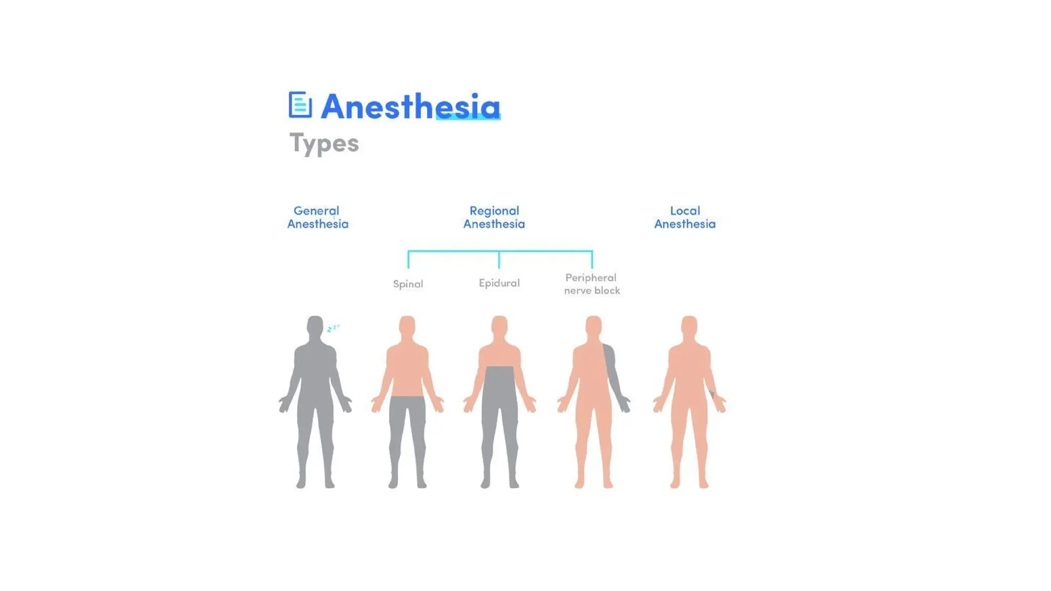 Local anaesthetics, Types of anaesthesia, classification, mechanism of ...