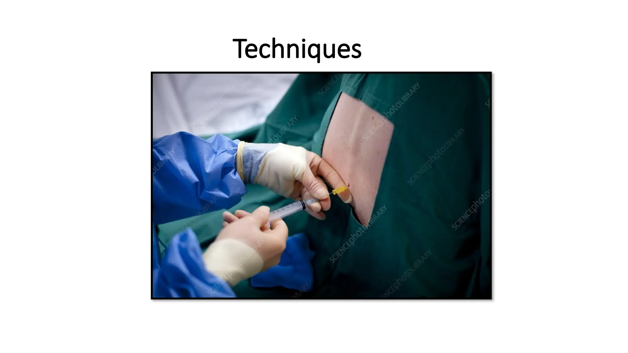 Local anaesthetics, Types of anaesthesia, classification, mechanism of ...