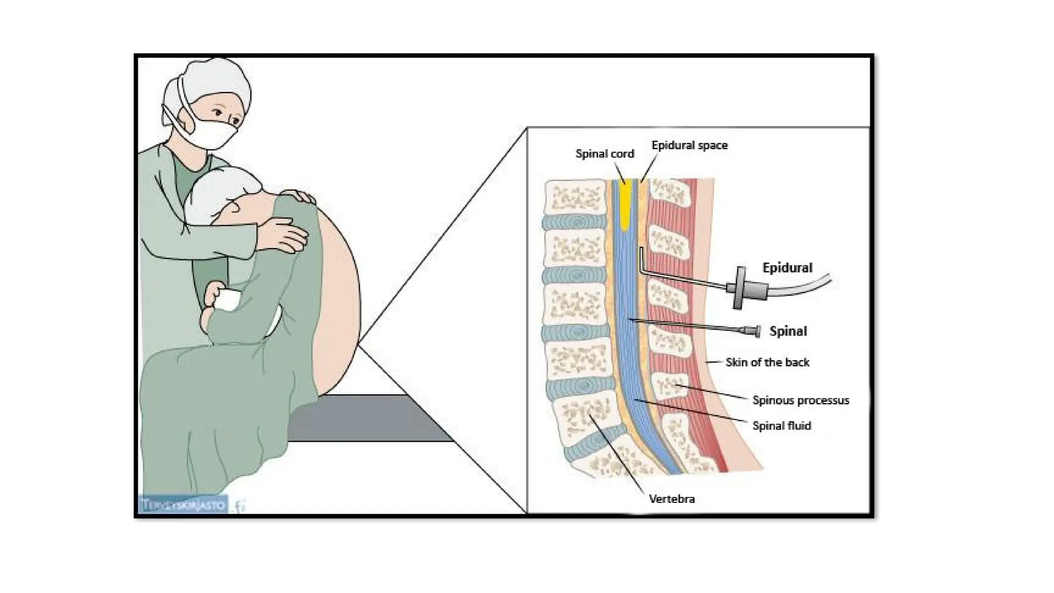 Local anaesthetics, Types of anaesthesia, classification, mechanism of ...