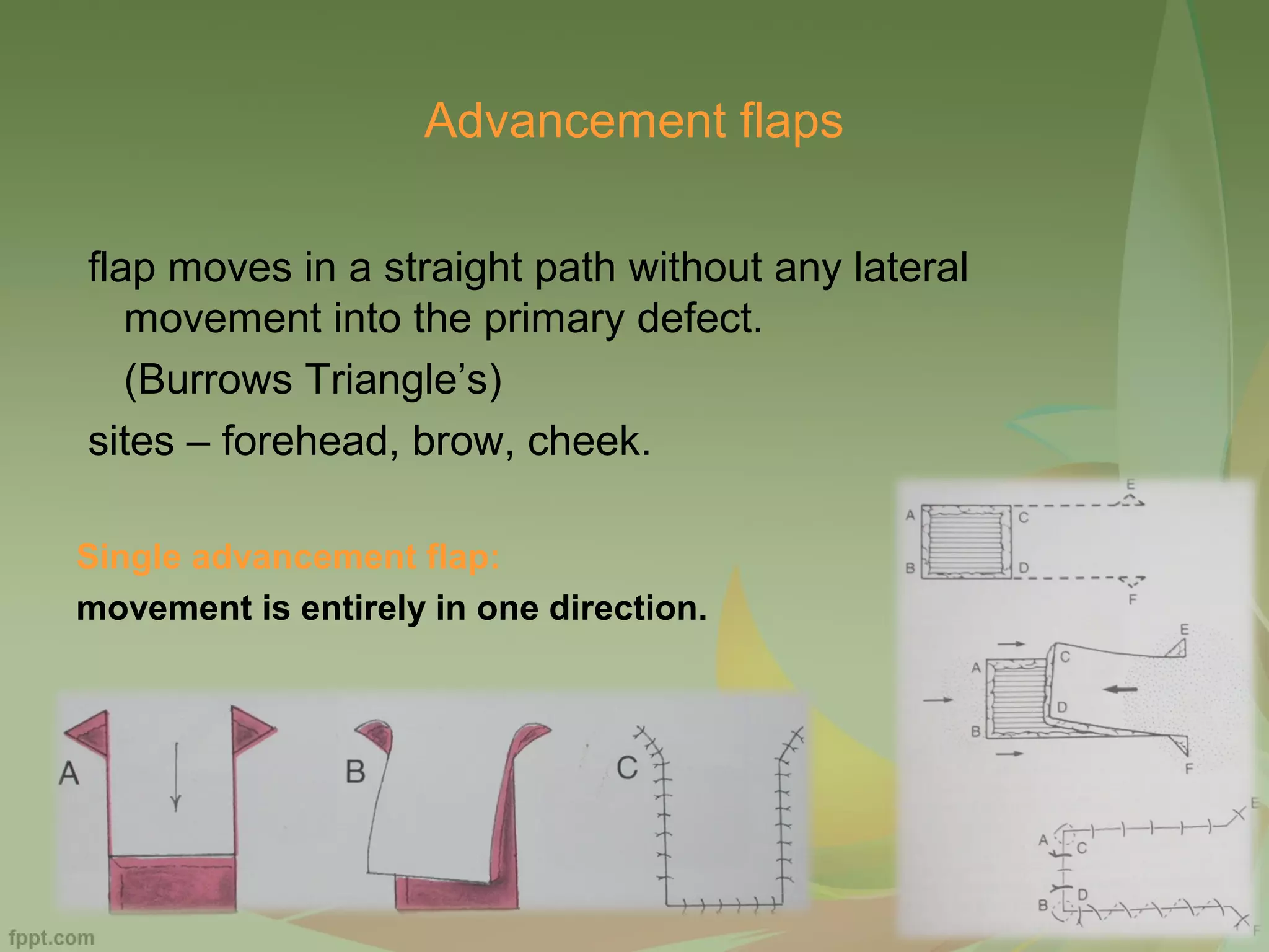 Local flaps in head & neack reconstruction | PPT