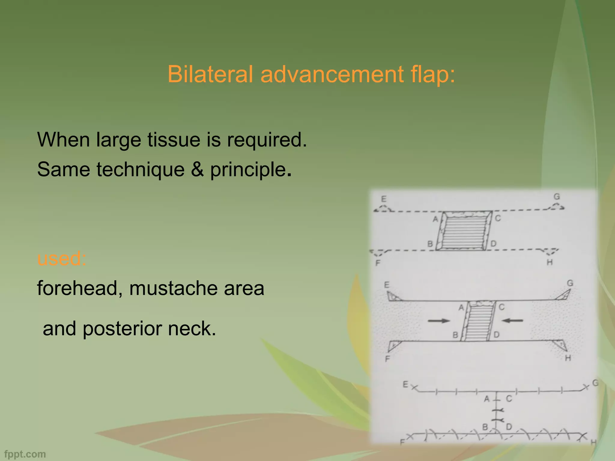 Local flaps in head & neack reconstruction | PPT