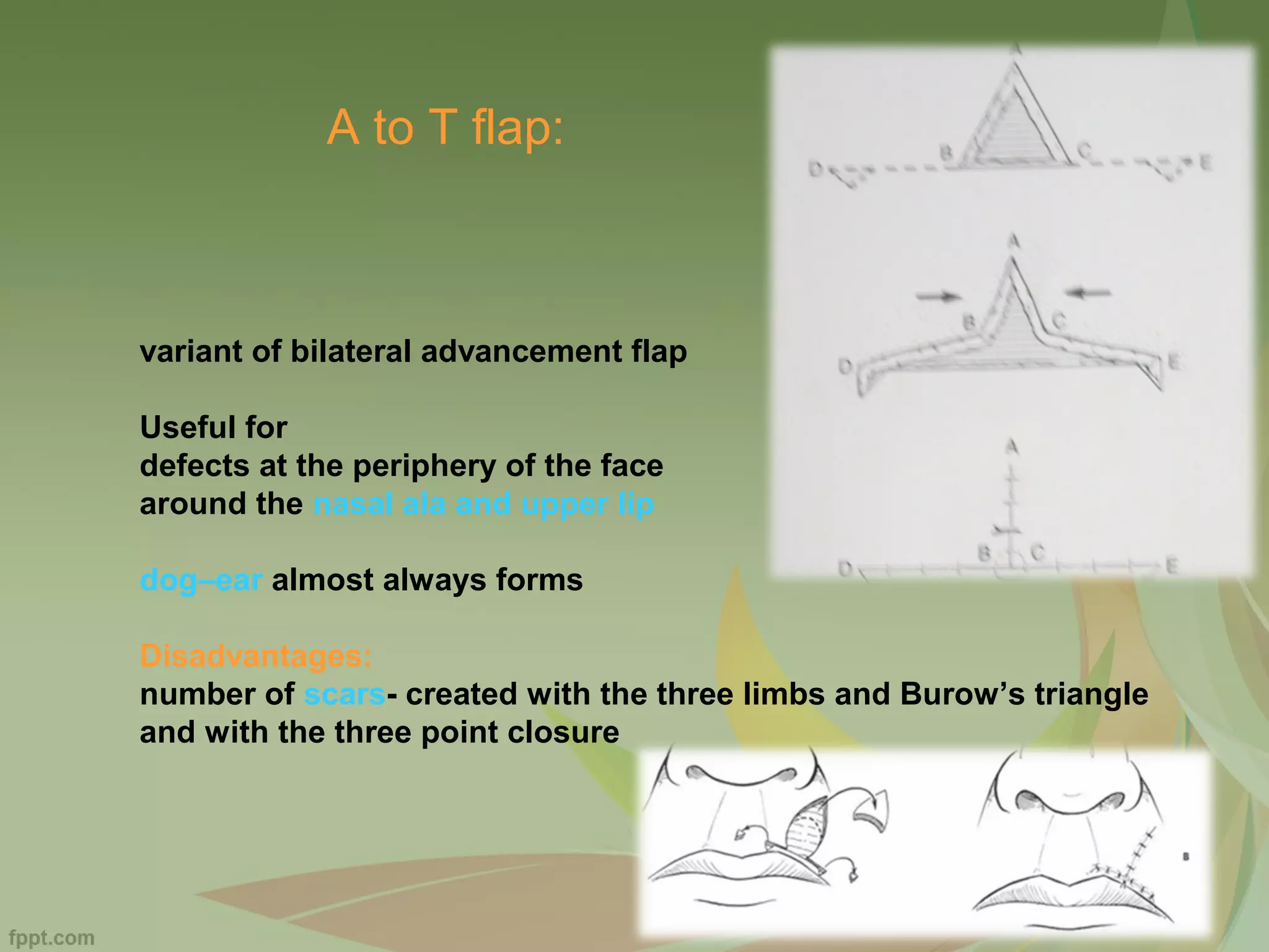 Local flaps in head & neack reconstruction | PPT