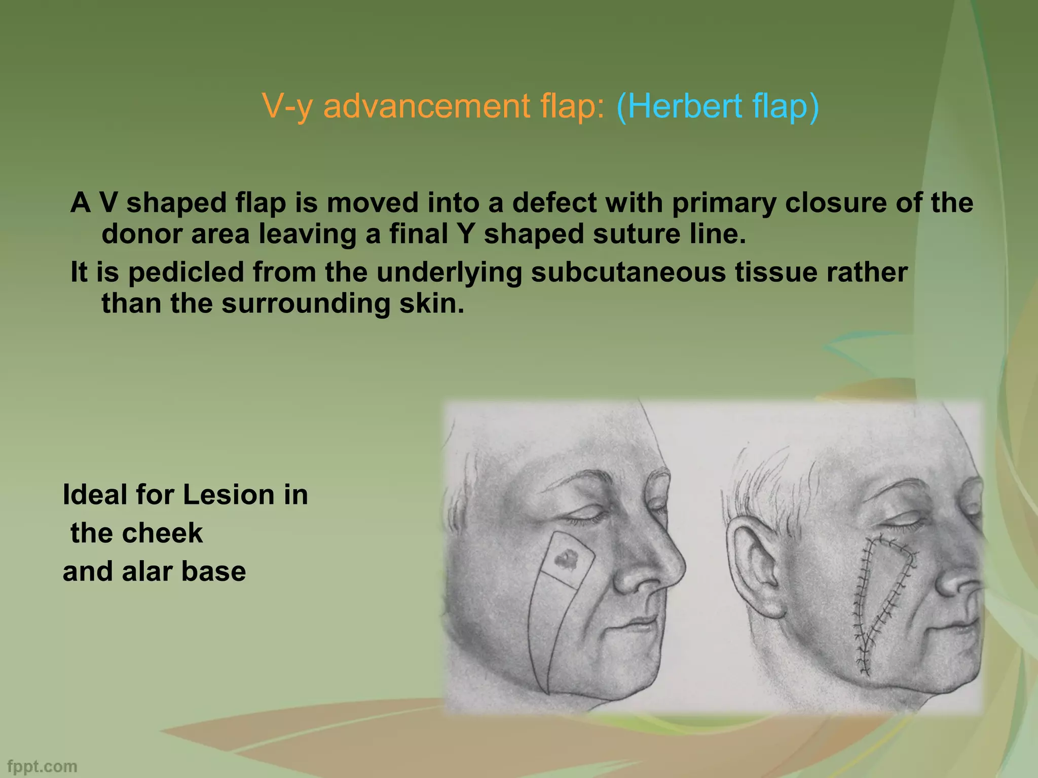 Local flaps in head & neack reconstruction | PPT