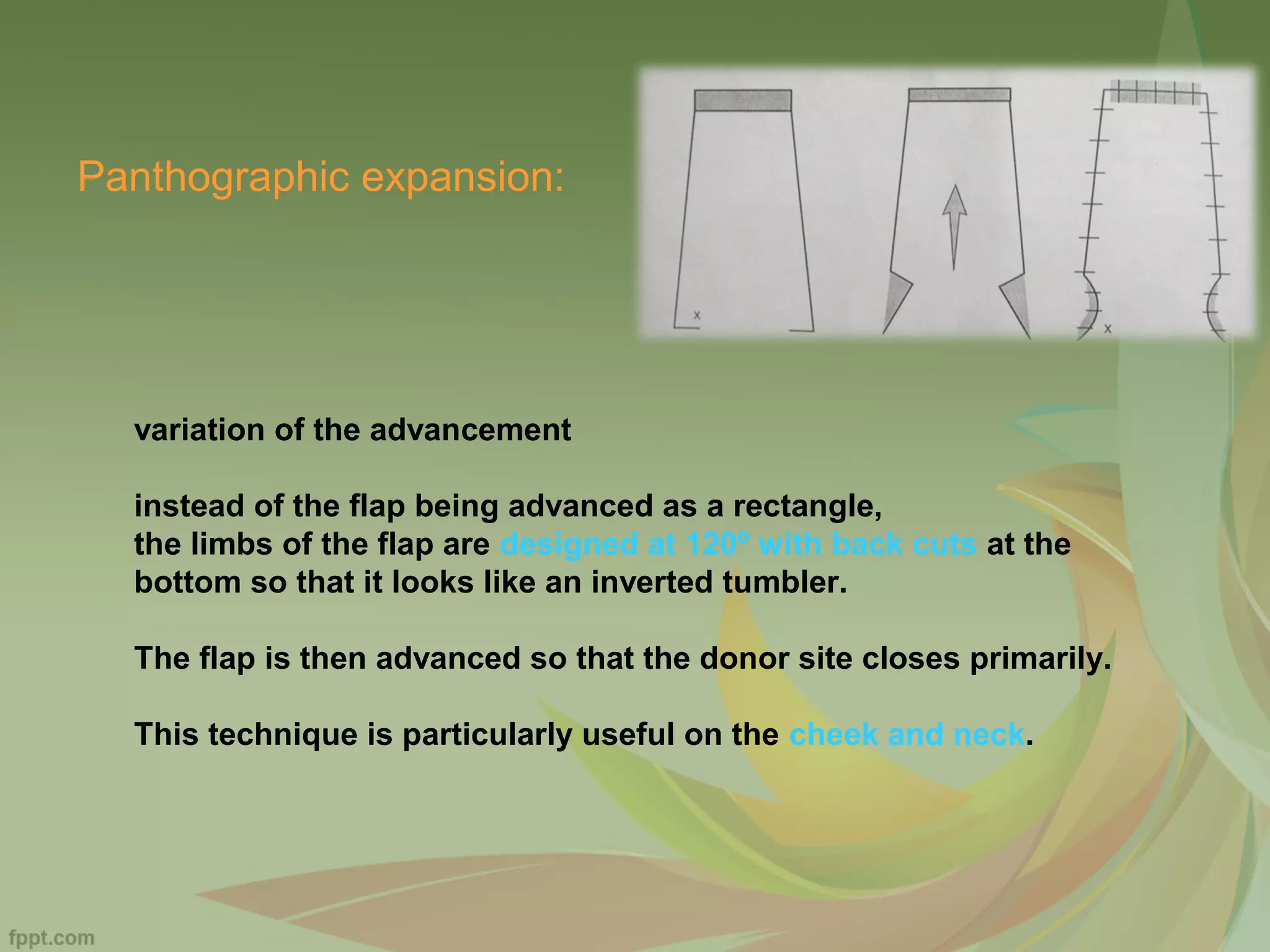 Local flaps in head & neack reconstruction | PPT