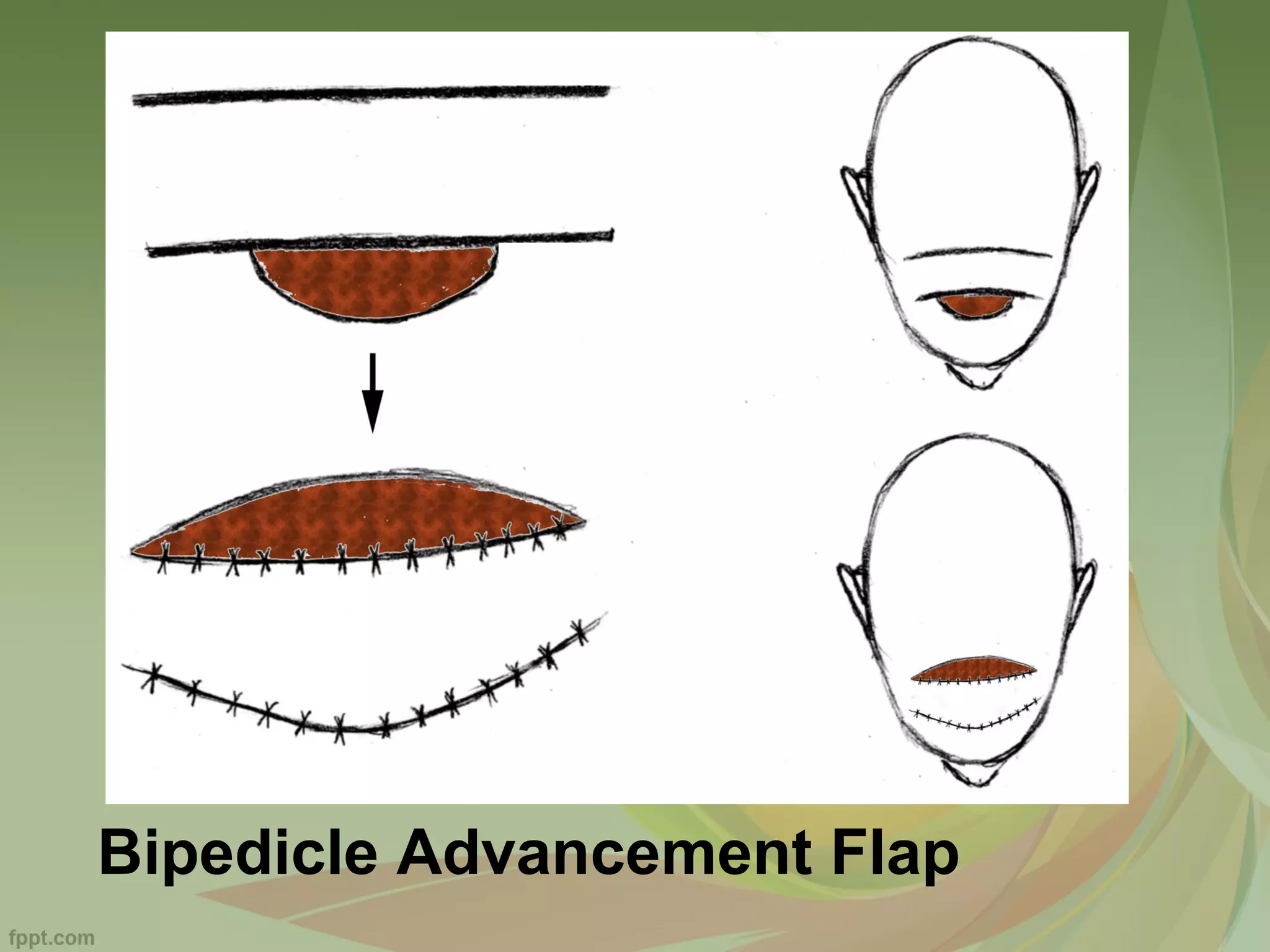 Local flaps in head & neack reconstruction | PPT