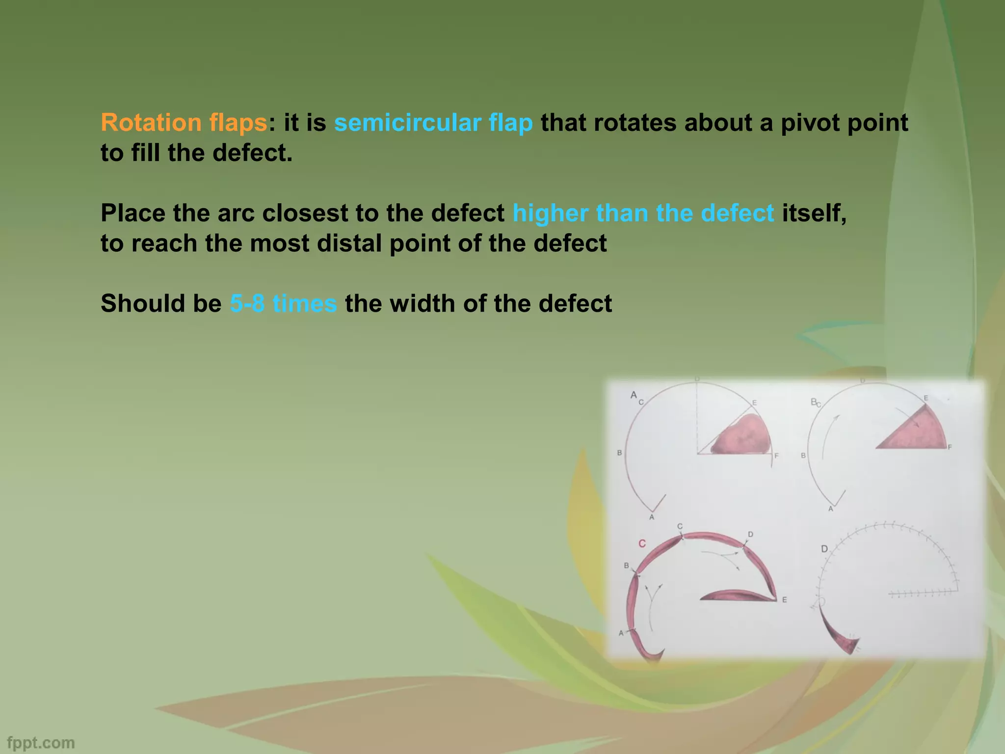 Local flaps in head & neack reconstruction | PPT