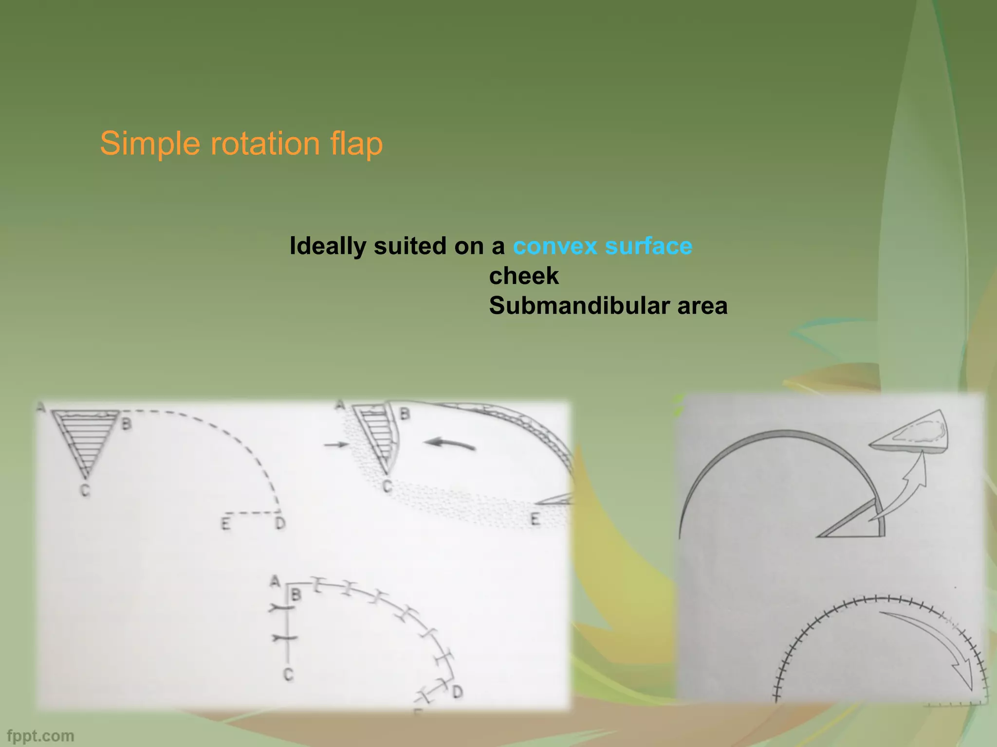 Local flaps in head & neack reconstruction | PPT