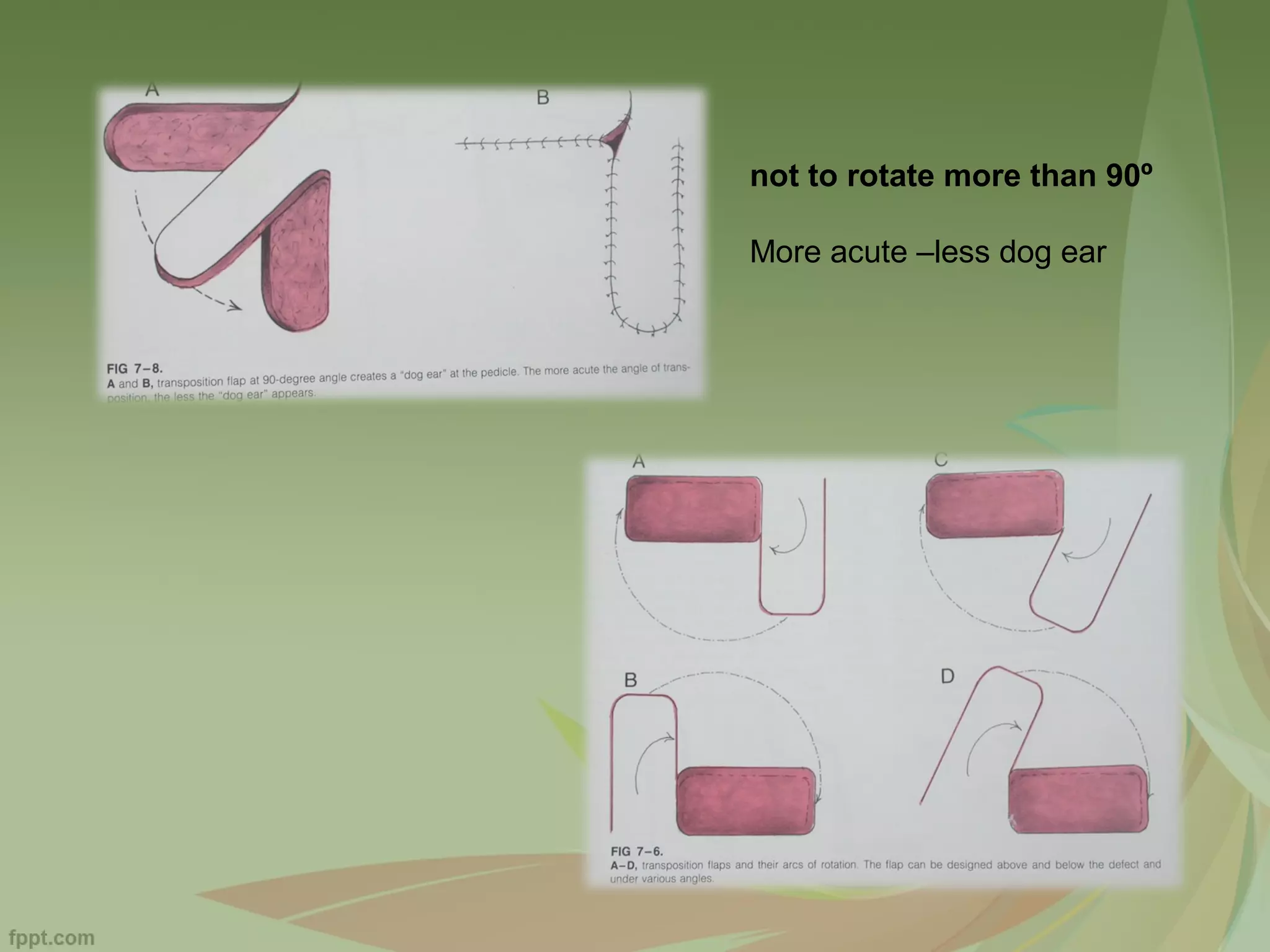 Local flaps in head & neack reconstruction | PPT