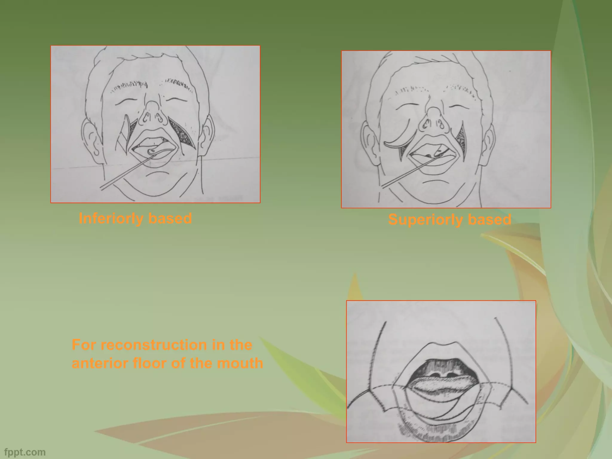 Local flaps in head & neack reconstruction | PPT