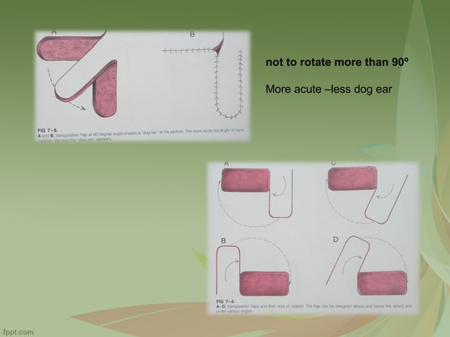 Local flaps in head & neack reconstruction | PPT | First Aid | Injuries