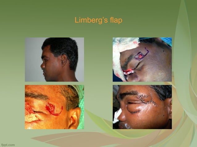 Local flaps in head & neack reconstruction | PPT | First Aid | Injuries