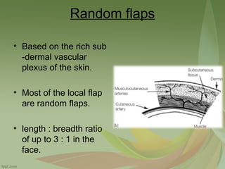 Local flaps in head & neack reconstruction | PPT