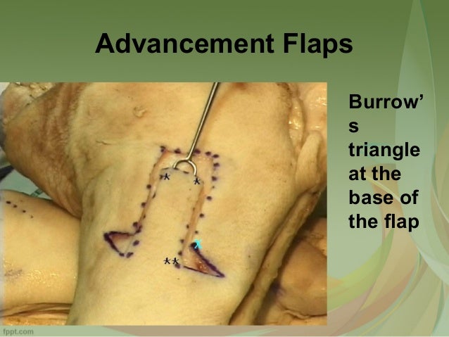 Local flaps in head & neack reconstruction