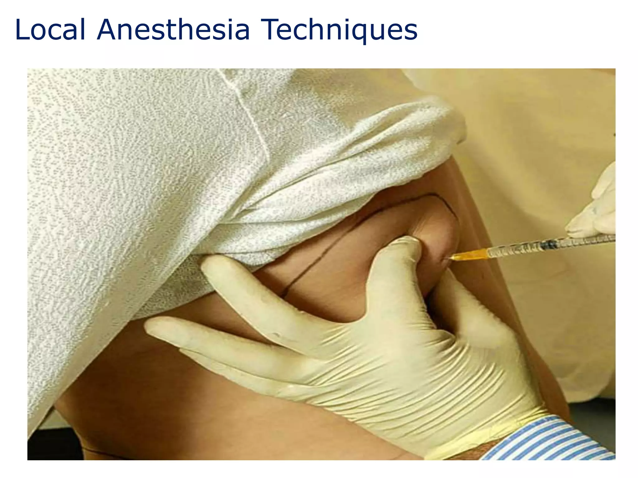 Local and regional anesthesia | PPT