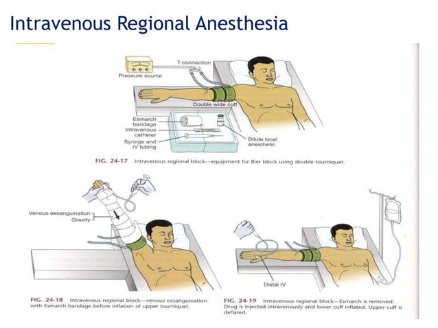 Local and regional anesthesia | PPT