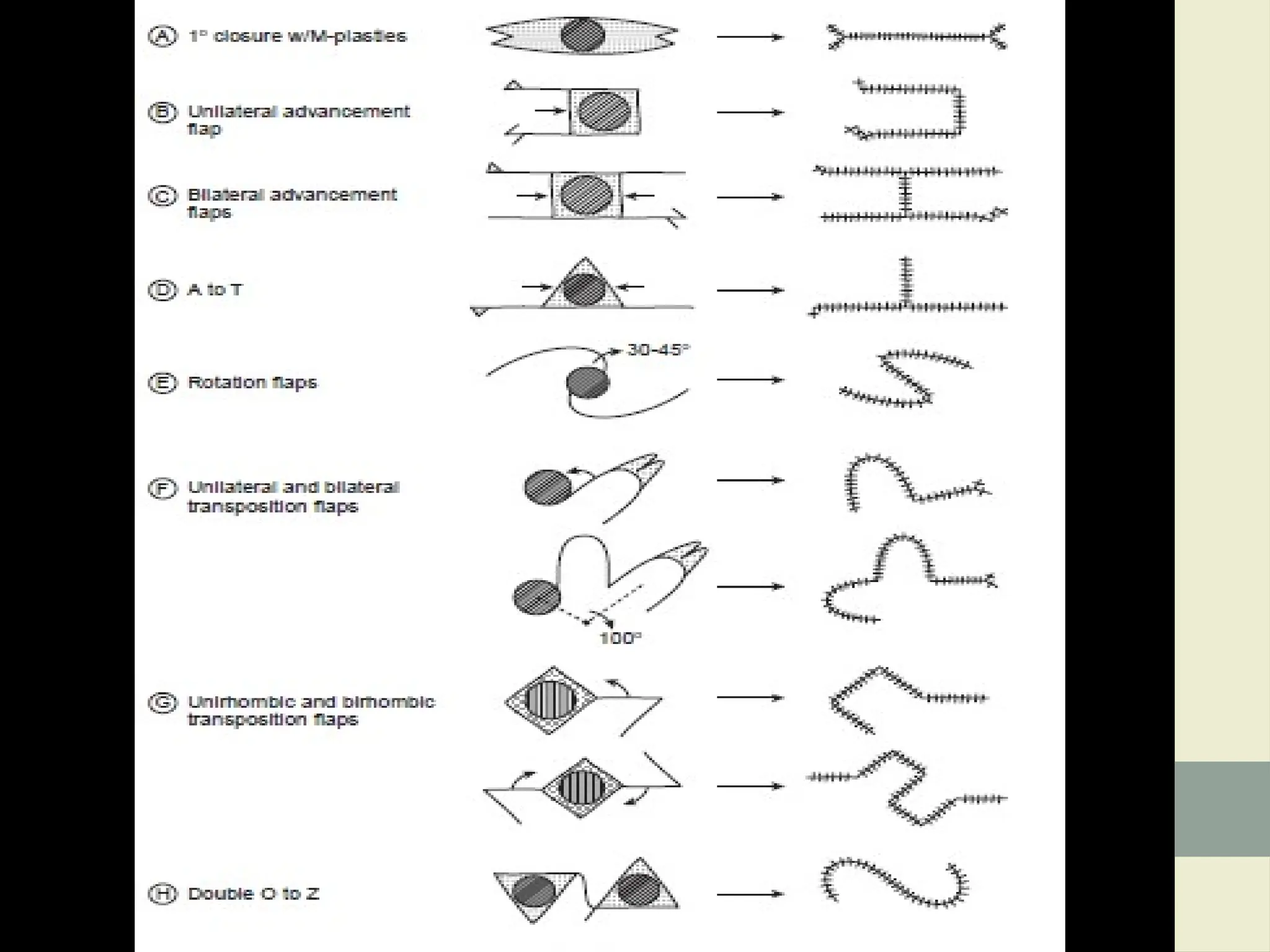 LOCAL AND REGIONAL FLAPS IN ORAL SURGERY.pptx