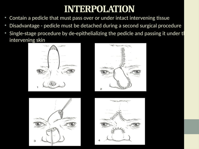 LOCAL AND REGIONAL FLAPS IN ORAL SURGERY.pptx | Cosmetic Medical ...