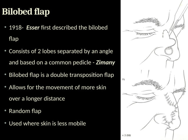 LOCAL AND REGIONAL FLAPS IN ORAL SURGERY.pptx | Cosmetic Medical ...