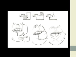 LOCAL AND REGIONAL FLAPS IN ORAL SURGERY.pptx