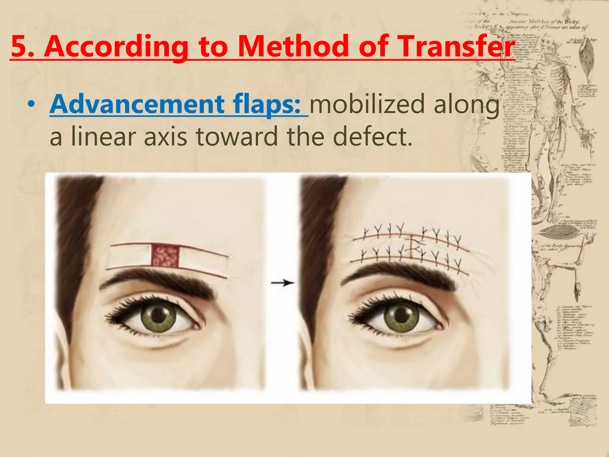 Local and regional flaps in head and neck reconstruction | PPTX
