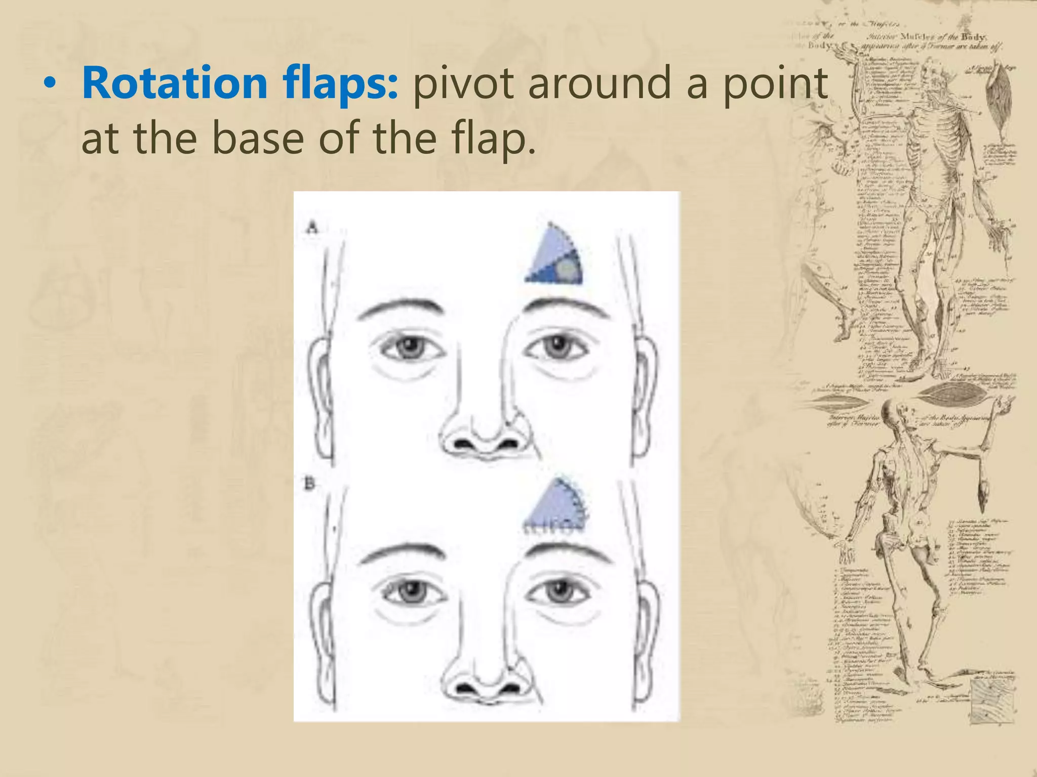 Local and regional flaps in head and neck reconstruction | PPTX