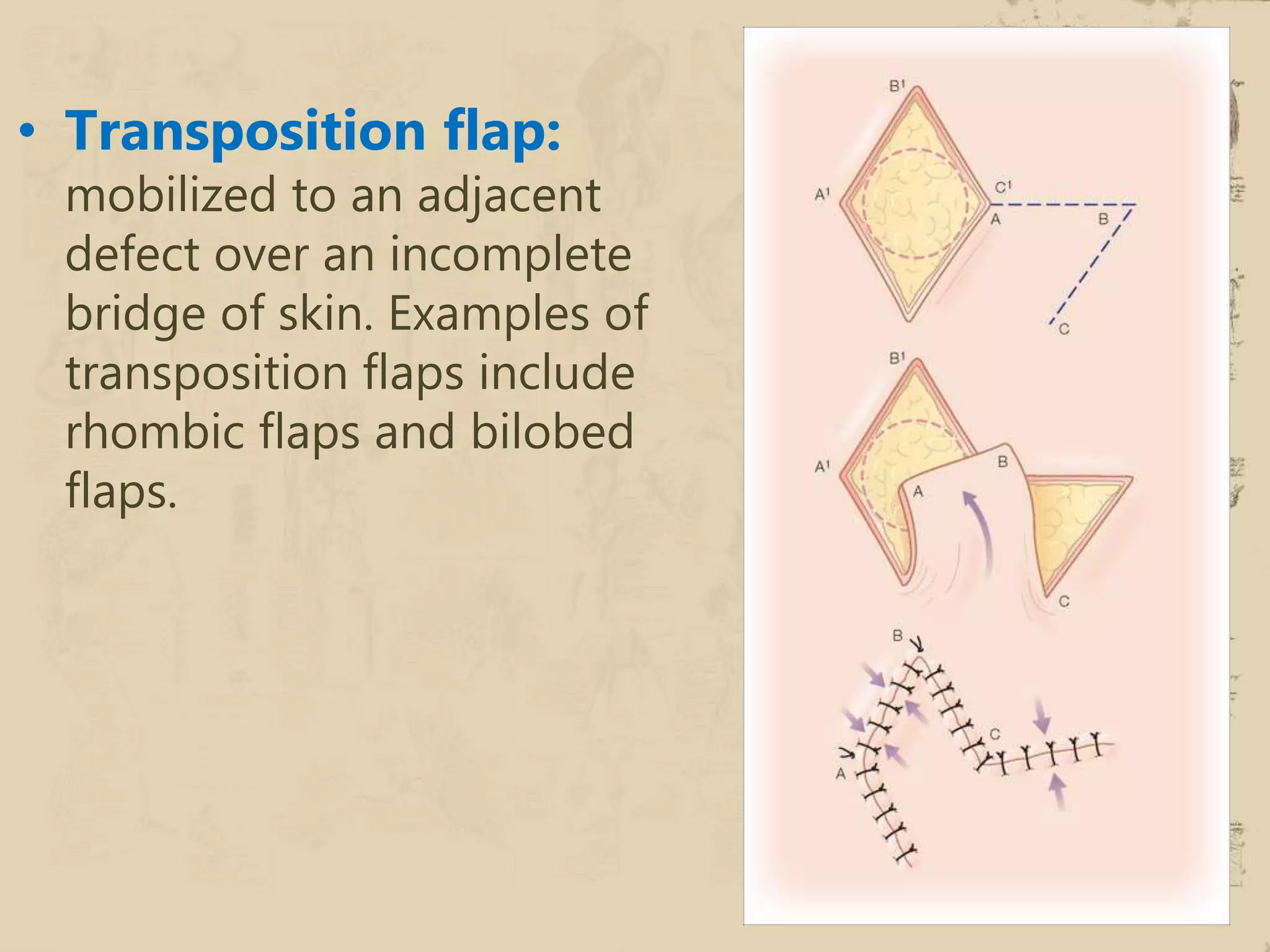 Local and regional flaps in head and neck reconstruction | PPTX