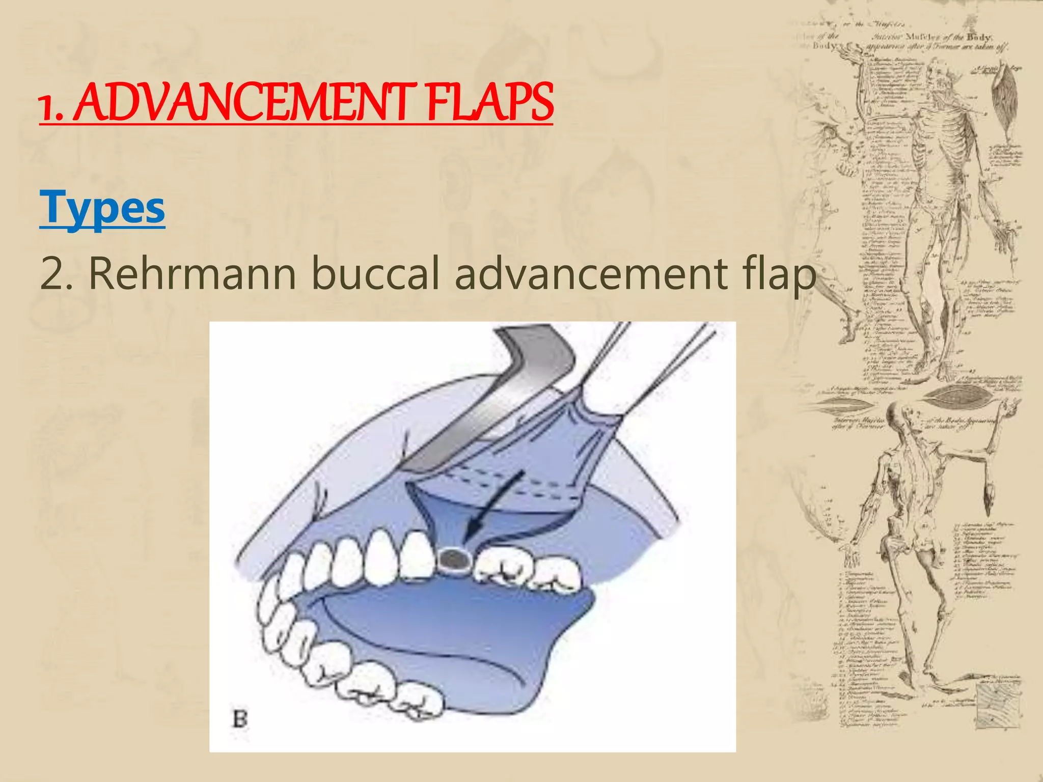 Local and regional flaps in head and neck reconstruction | PPTX