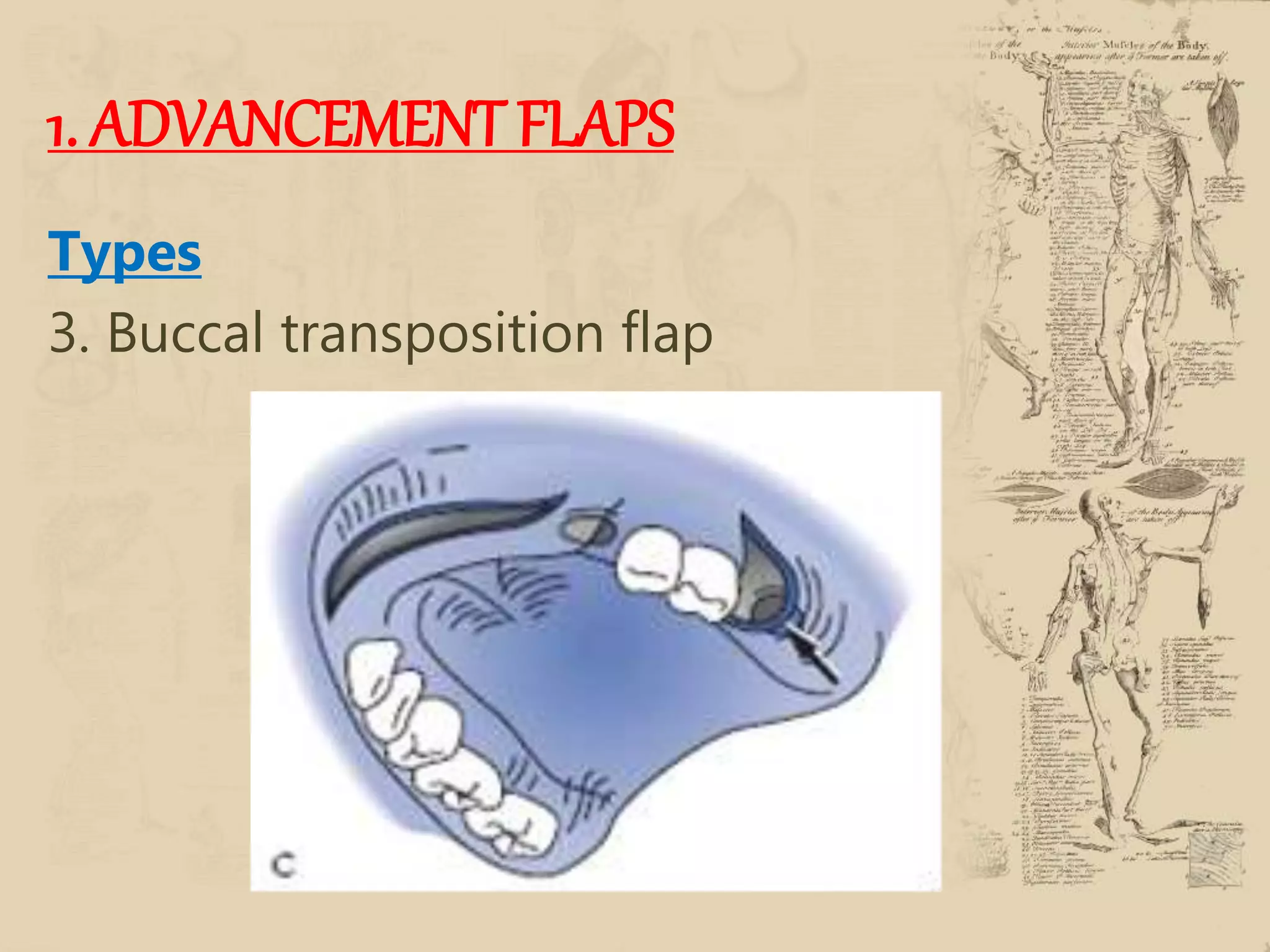 Local and regional flaps in head and neck reconstruction | PPTX