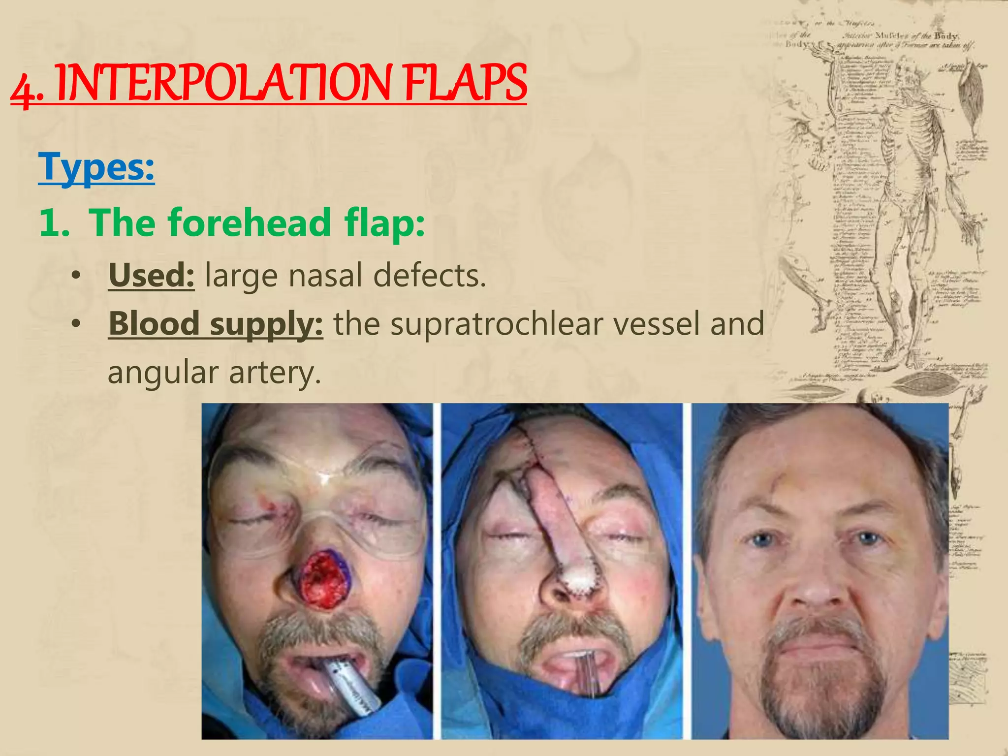 Local and regional flaps in head and neck reconstruction | PPTX