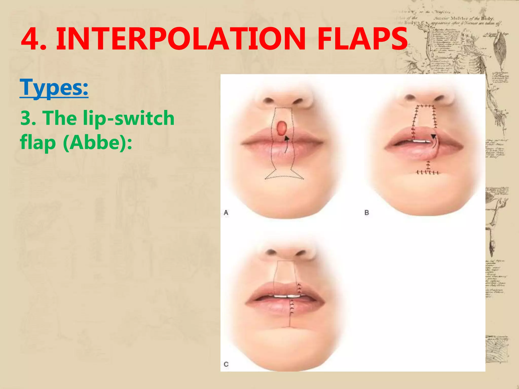 Local and regional flaps in head and neck reconstruction | PPTX