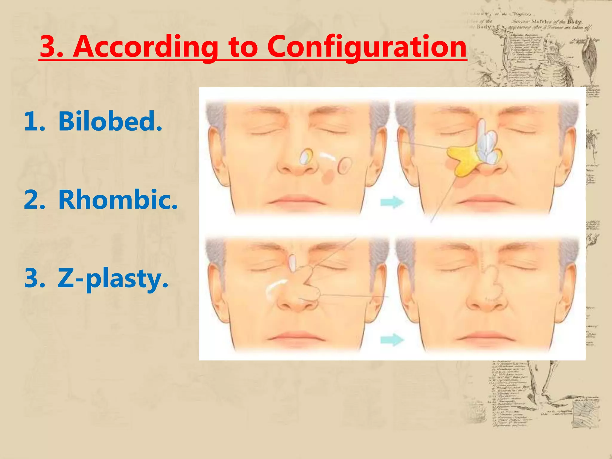 Local and regional flaps in head and neck reconstruction | PPTX